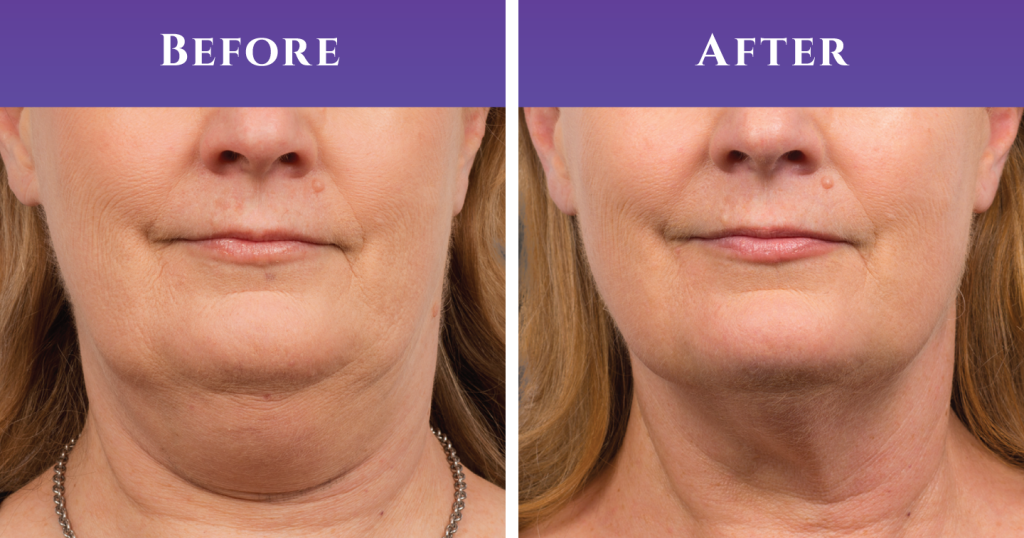 Double Chin Treatment - New Creation MediCosmetic MediCosmetic Centre