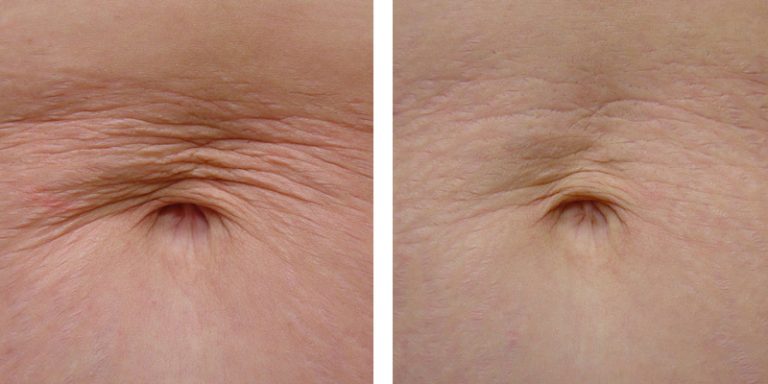 Non-invasive Skin Tightening Treatments - New Creation MediCosmetic