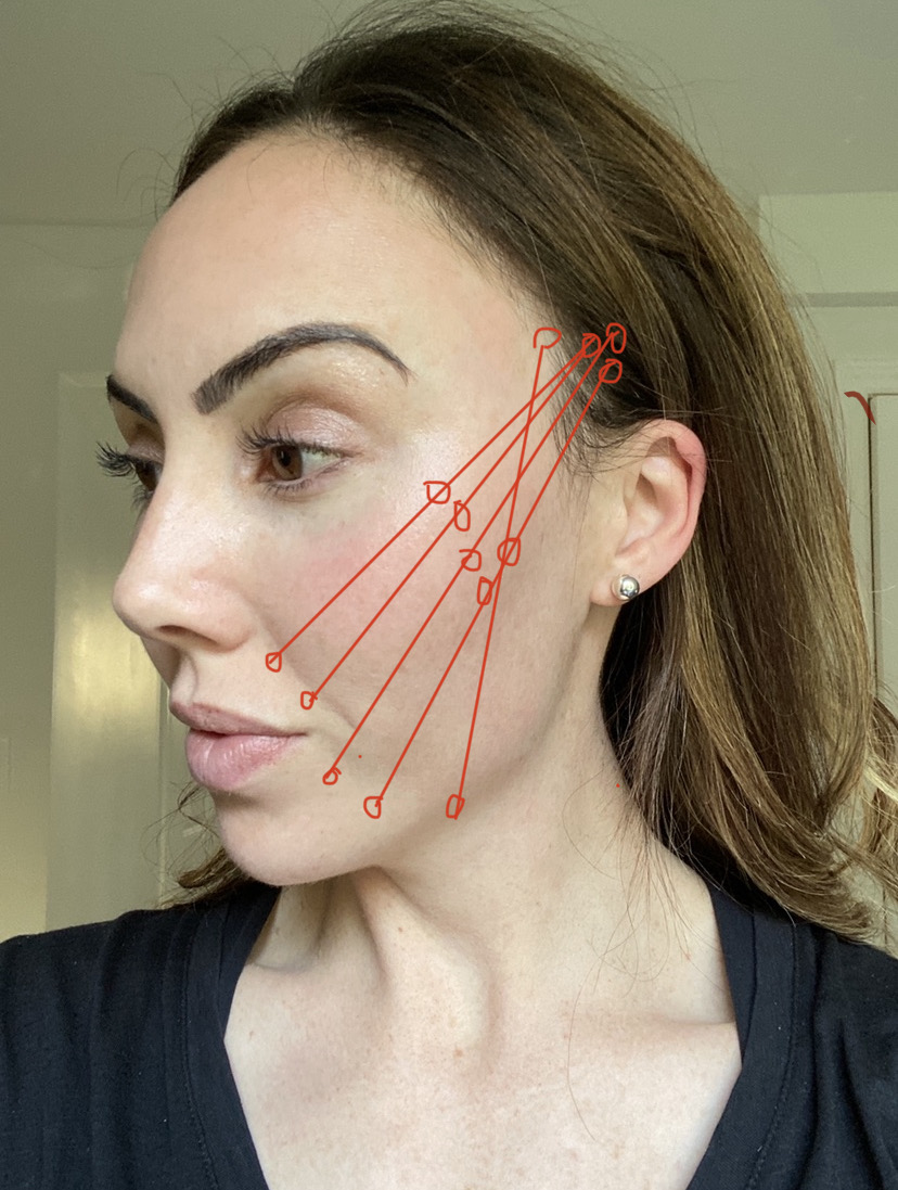 Non-Surgical Thread Lift - New Creation MediCosmetic MediCosmetic Centre